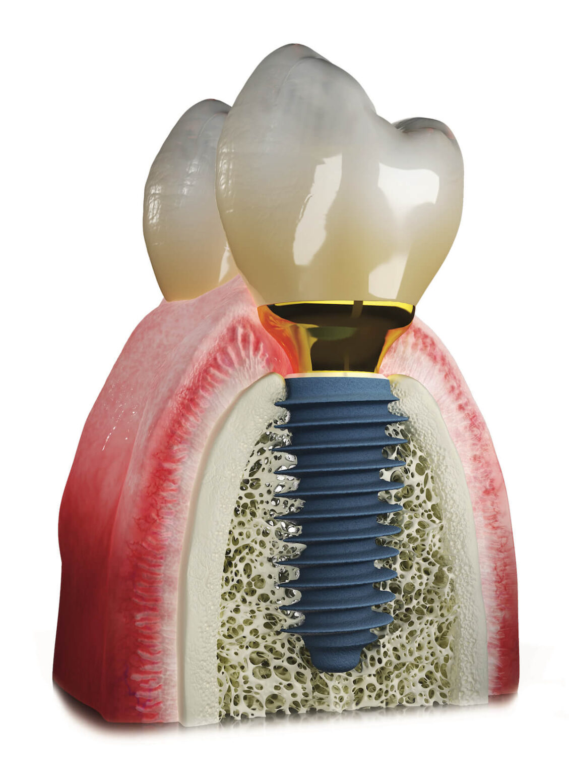 Mis on implantaat? Millal ja miks seda eelistada? | K3 Hambaravi